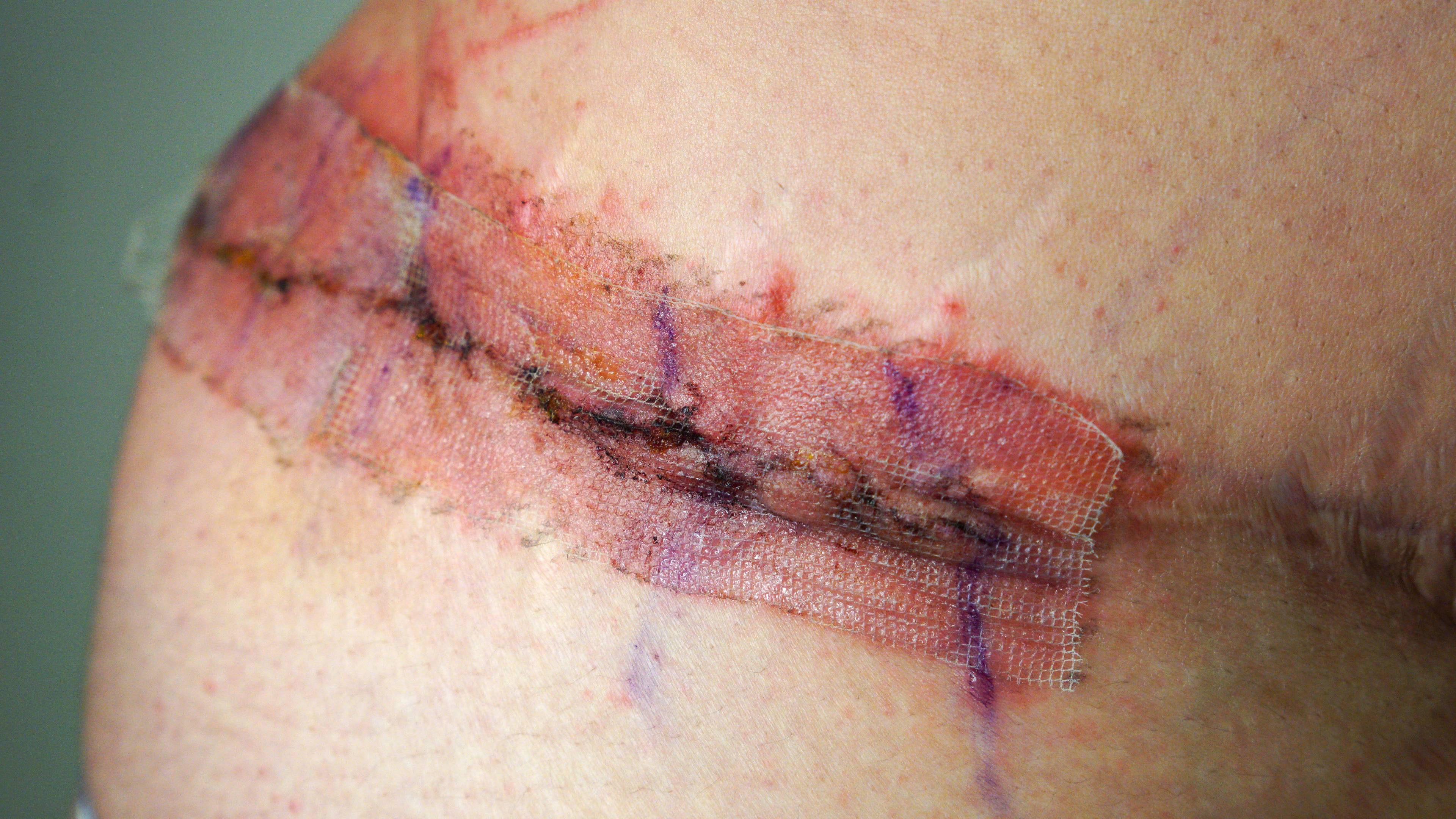 SYLKE® Adhesive Wound Closure | SYLKE®