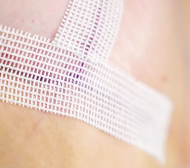 SYLKE® Adhesive Wound Closure | SYLKE®